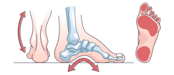 Holvoeten (Pes Cavus) - Informatie & de behandeling - Skystep